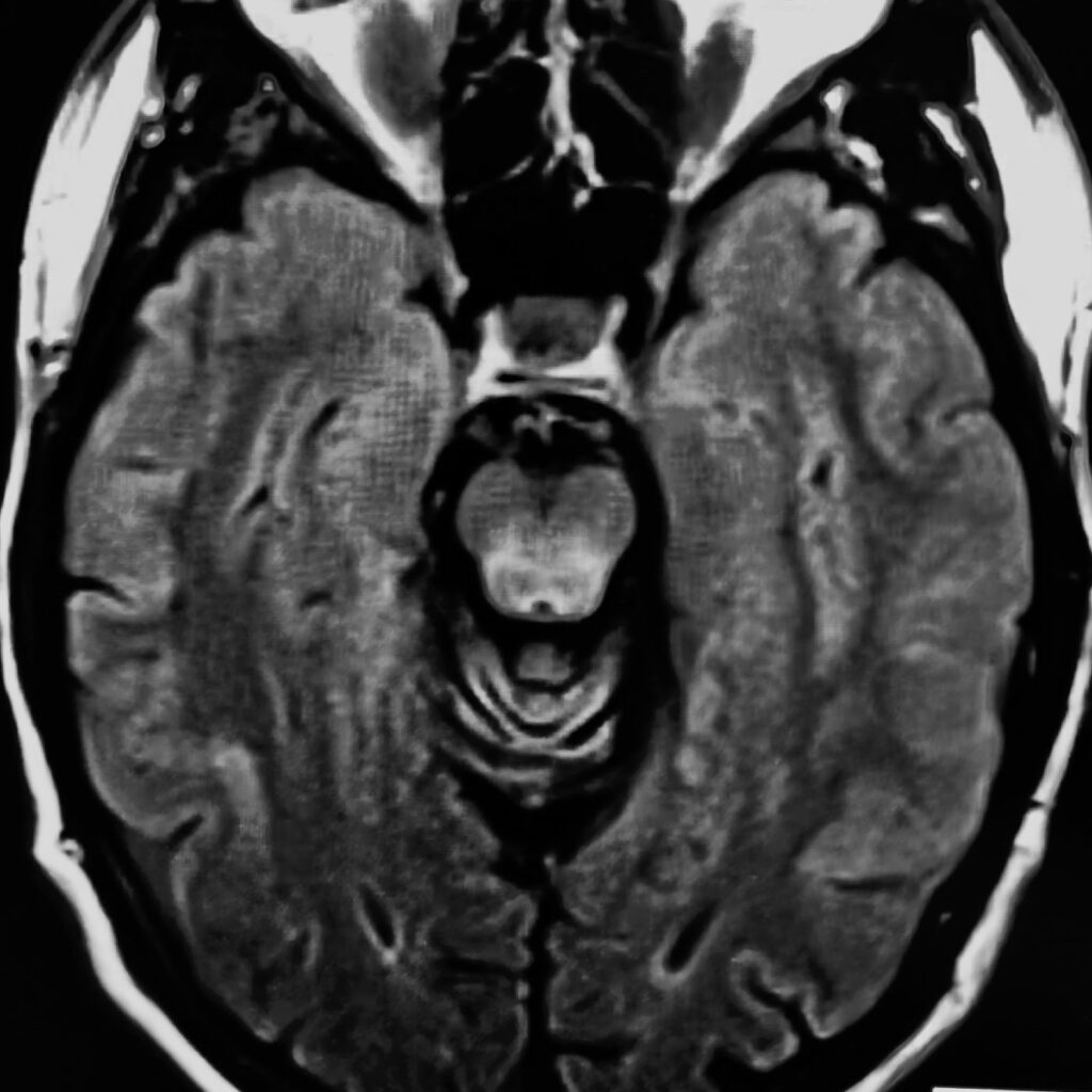 Patient Stories - W - Wilson Disease Association